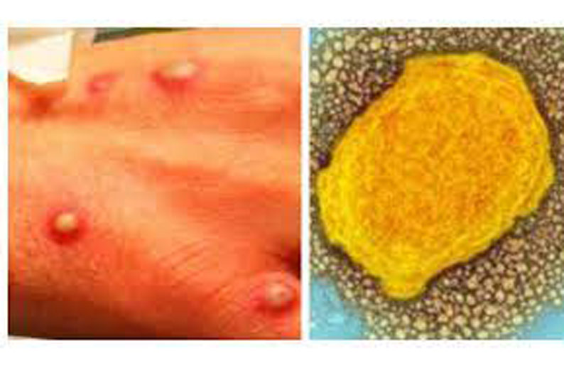 28 beds to treat monkey flu in Mumbai | மும்பையில் குரங்கு ...