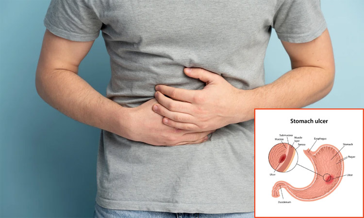 Stomach Ulcer: Signs, Symptoms, Causes and siddha Treatment | வயிற்றுப் ...