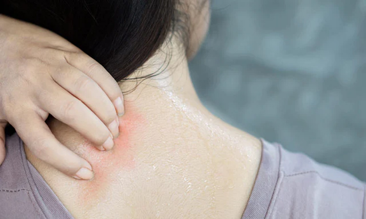 வியர்க்குருவை விரட்டும் வழிமுறைகள் | heat rashes remedies